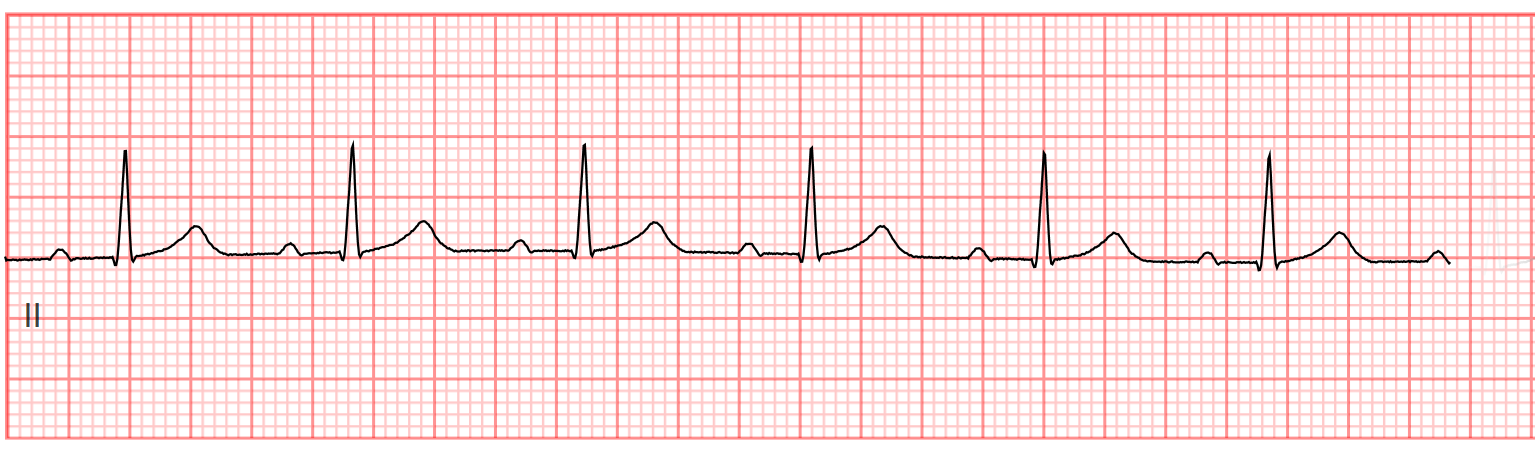 Atrioventricular Block - The Medical Cookbook
